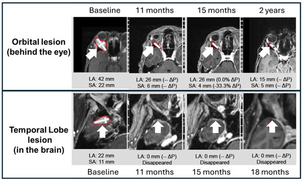 BriaCell Patients’ Images Show Regression and Resolution of ...